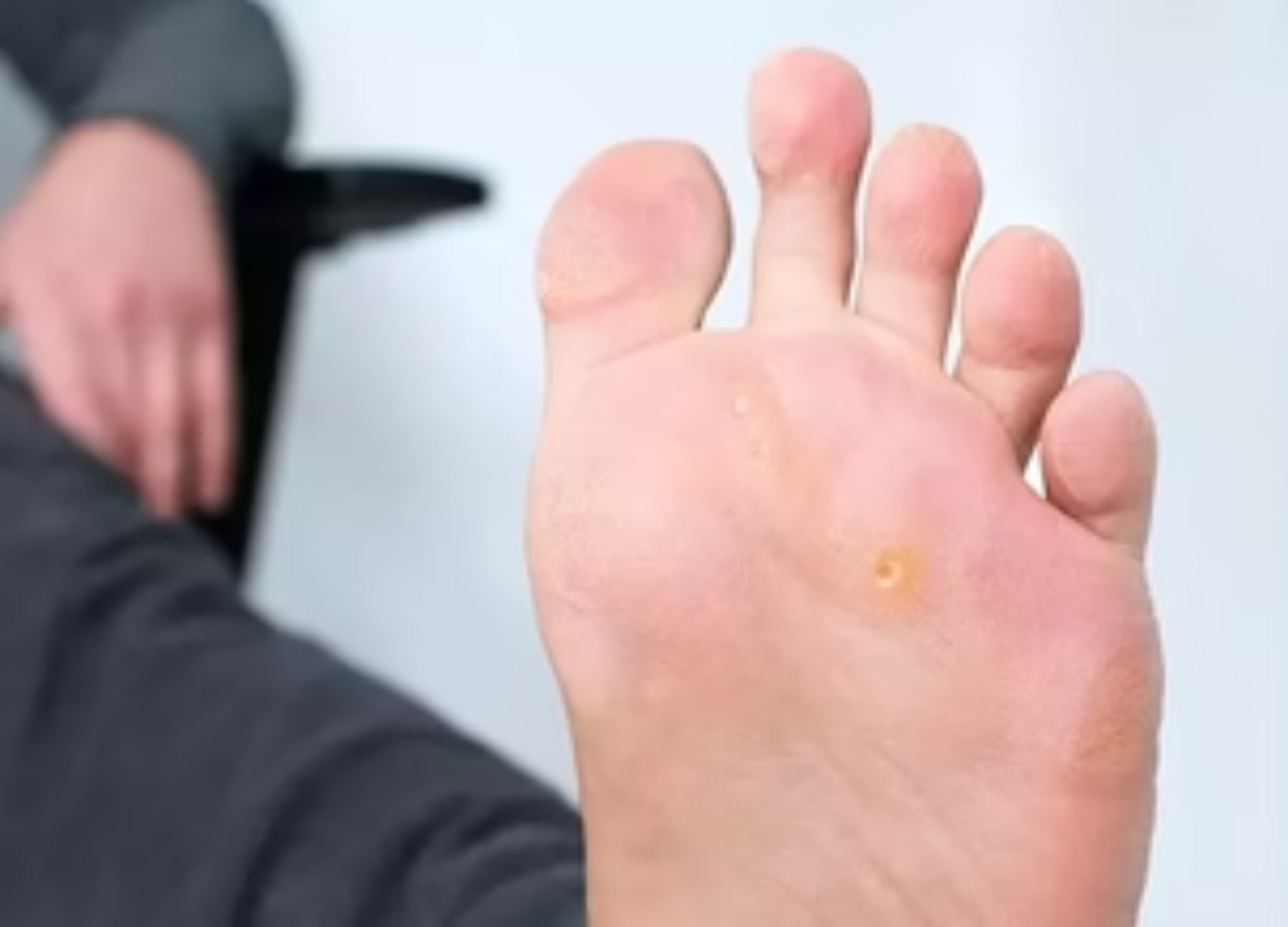 Corns & Plantar Warts (consultation fee) – Footology